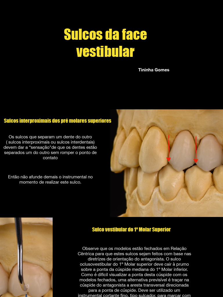 Sulcos Vestibulares em Dentes Superiores | PDF