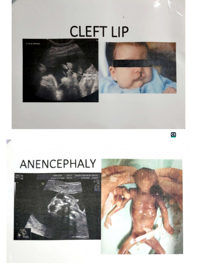 Fetal Scan Anomaly | PDF