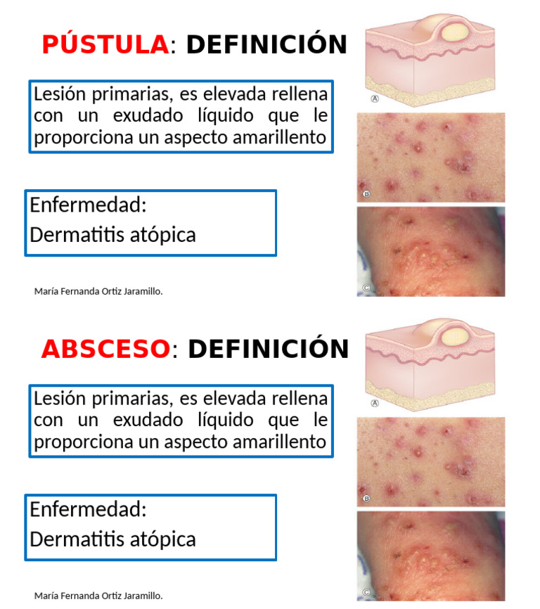 Pústula y Absceso en Dermatitis Atópica | PDF