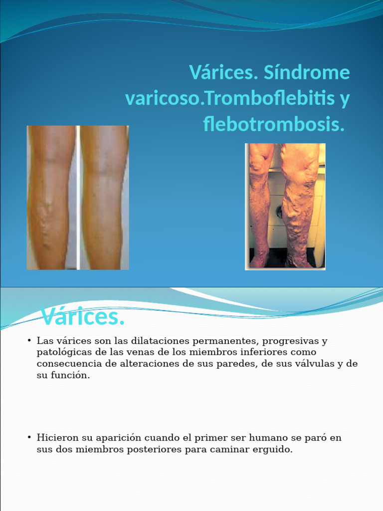 Várices: Causas, Anatomía y Riesgos | PDF | Vena | Venas varicosas