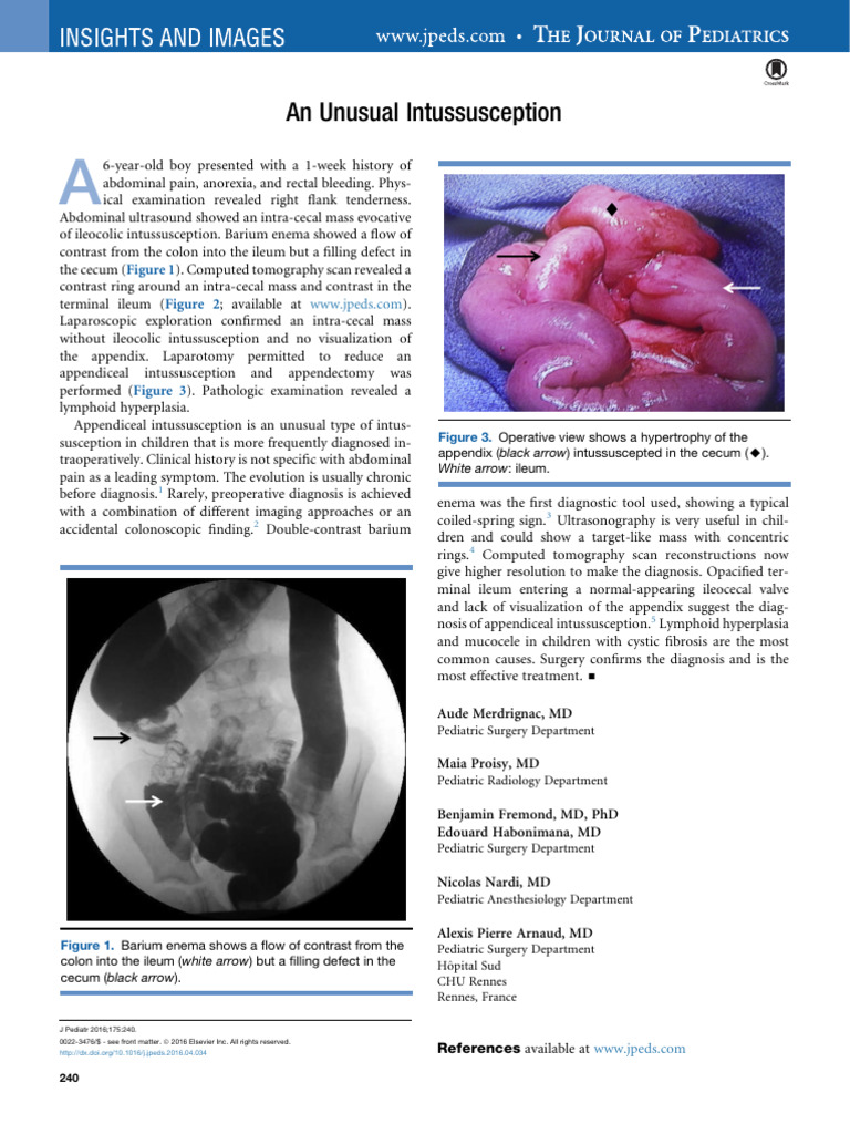 Appendiceal Intussusception in Children | PDF | Medical Specialties ...