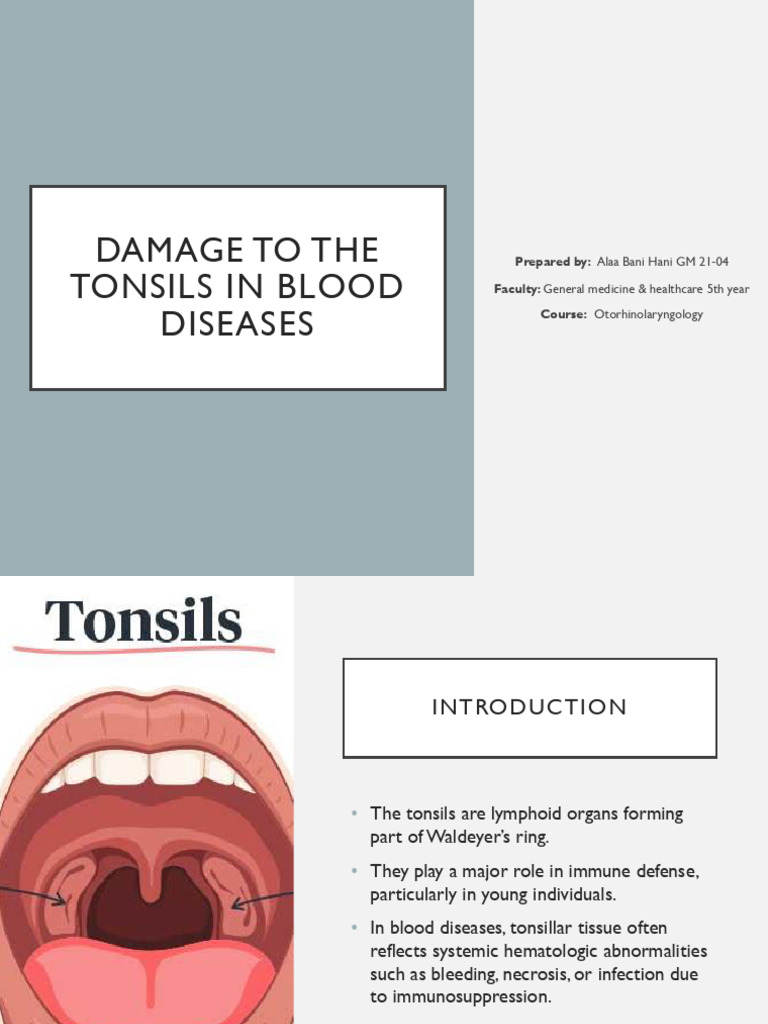 Damage To Tonsils in Blood Diseases | PDF | Lymphocyte | Lymphoma