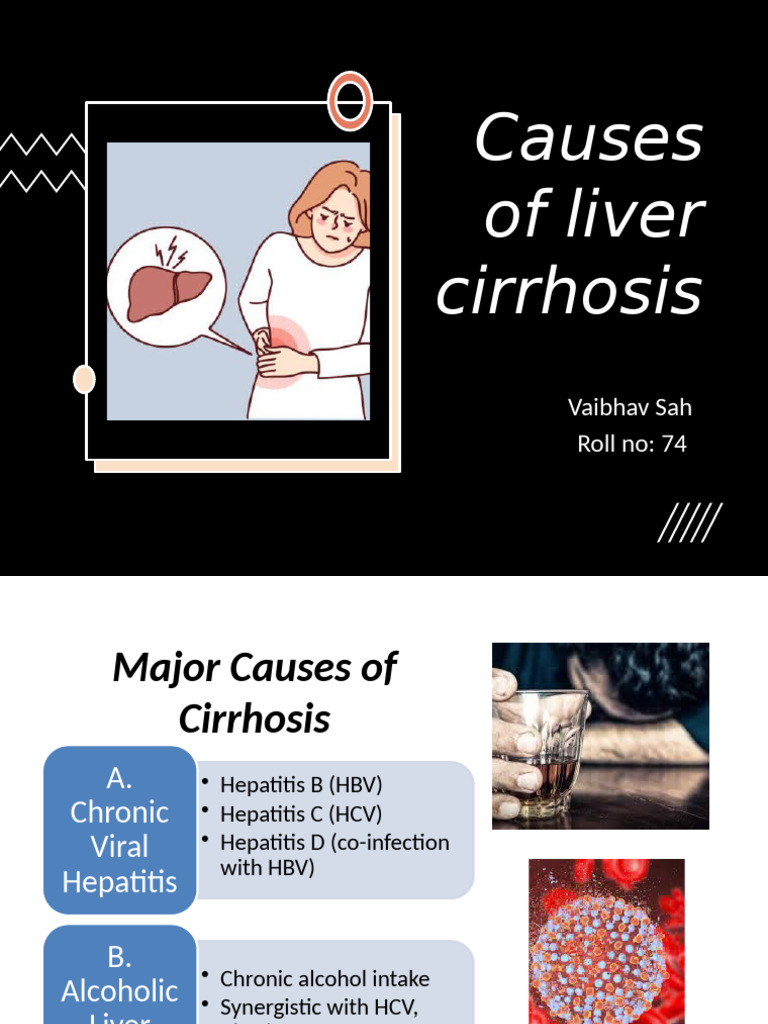 Cirrhosis Causes Harrison (1) New | PDF