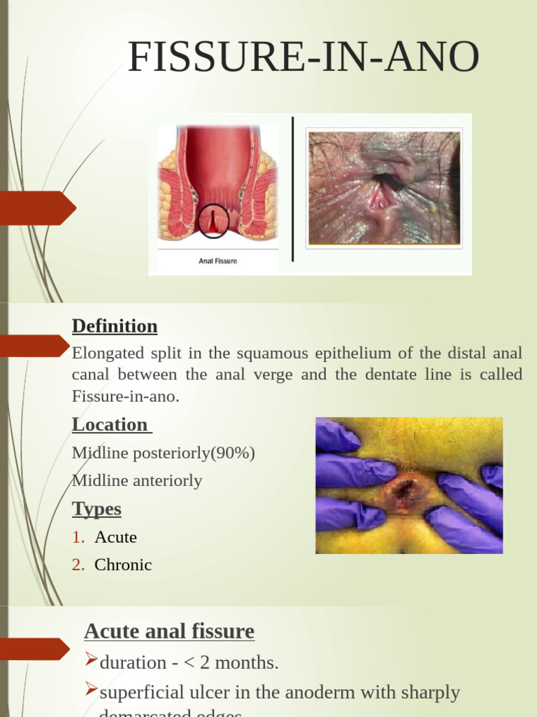 Fissure in Ano | PDF | Gastroenterology | Rectum