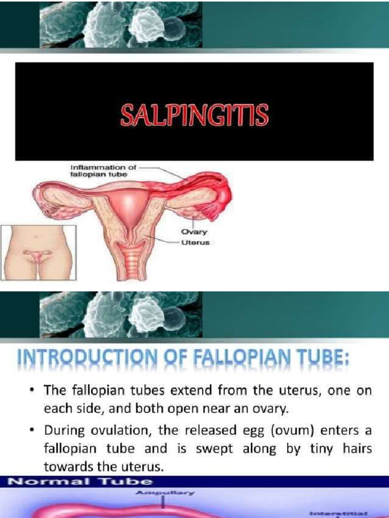 7 Salpingitis | PDF
