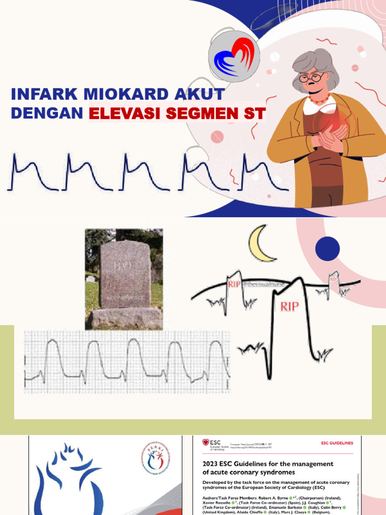 Elevasi Segmen ST: Infark Miokard Akut | PDF