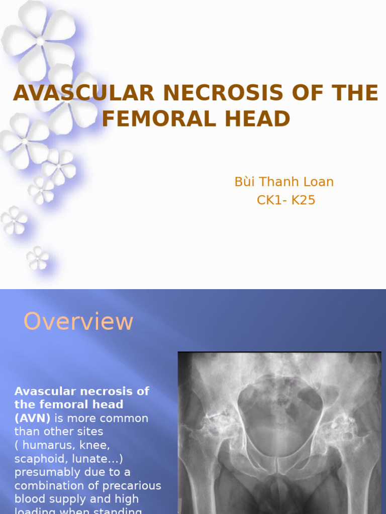 Avascular Necrosis of The Femoral Head AVN | PDF | Medical Specialties ...