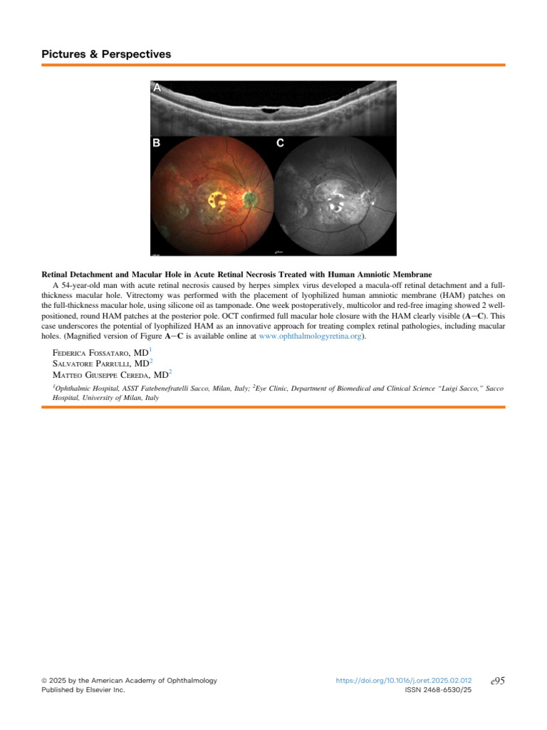 Retinal Detachment and Macular Hole in Acute Retin | PDF