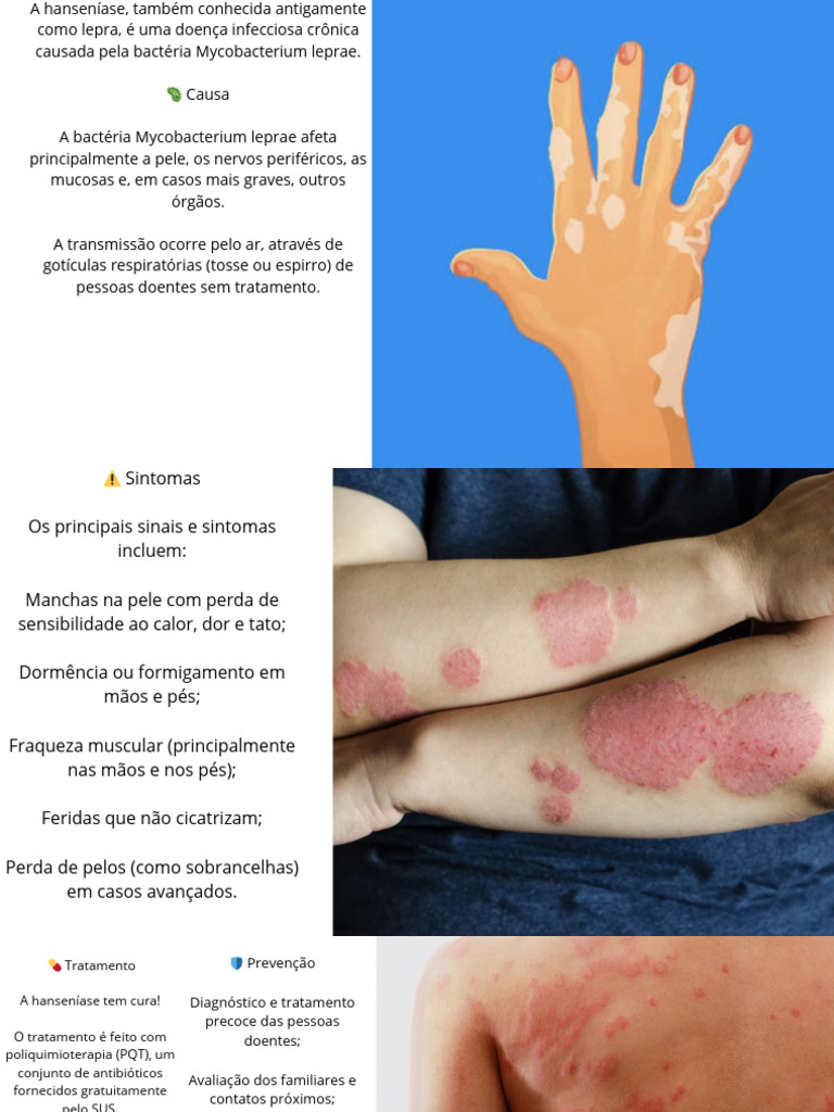 Hanseníase e Poliomielite: Causas e Prevenção | PDF | Lepra | Doenças e ...