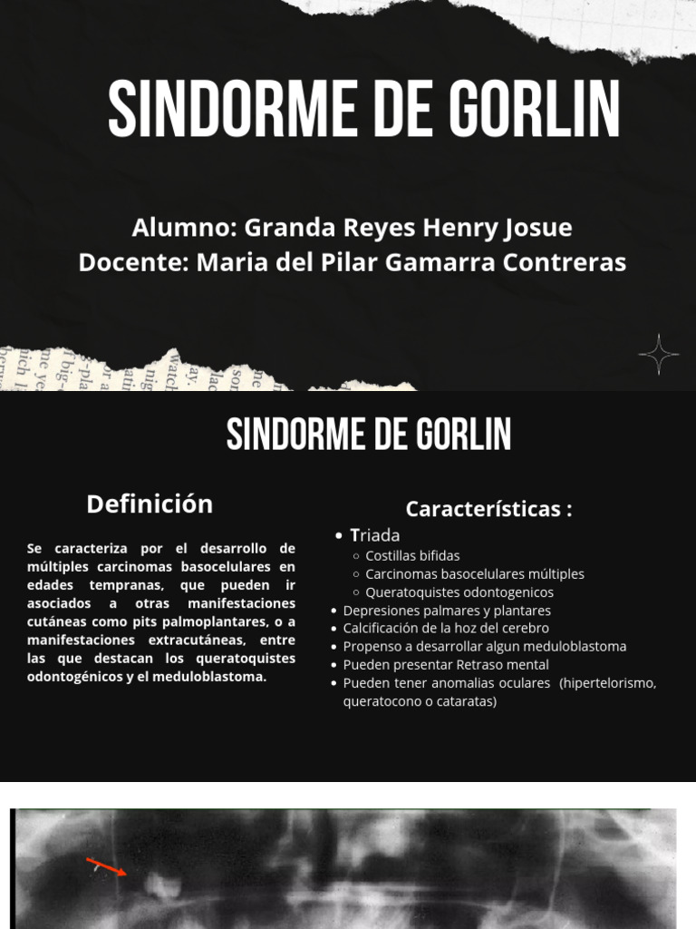 Síndrome de Gorlin: Características y Diagnóstico | PDF