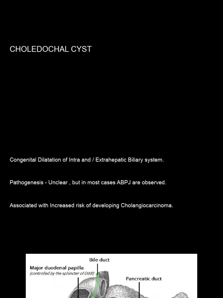 Understanding Choledochal Cysts and Treatment | PDF