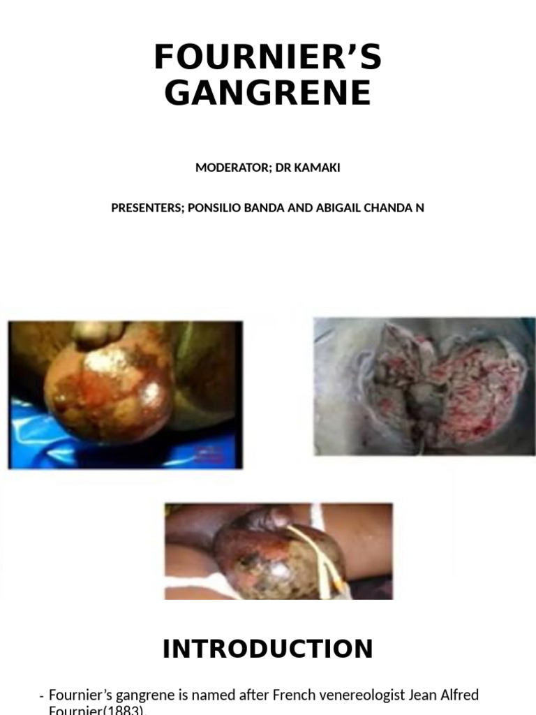 Fournier's Gangrene Overview and Management | PDF | Thrombus | Sepsis
