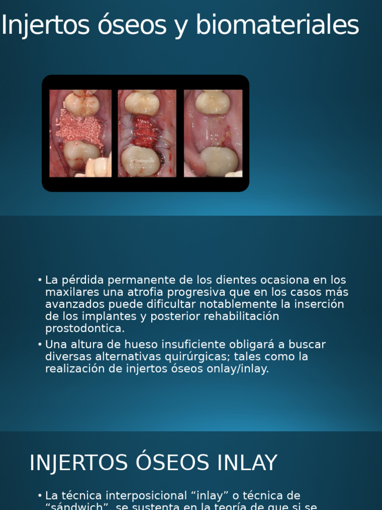 Injertos Óseos: Tipos y Técnicas Quirúrgicas | PDF | Hueso ...