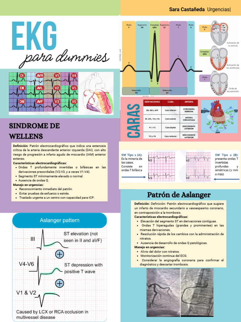 EKG: Síndrome de Wellens y Aslanger | PDF | Infarto de miocardio ...