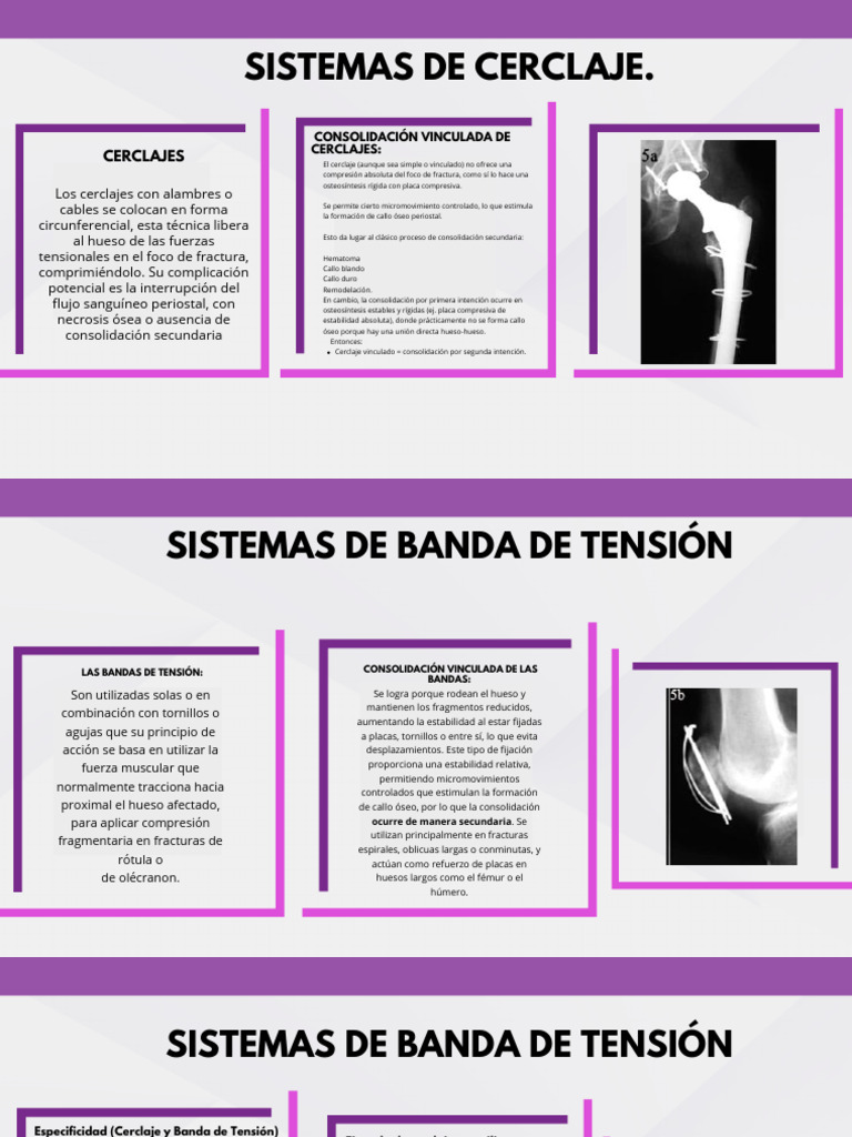 Sistemas de Cerclaje y Banda de Tensión | PDF | Hueso | Fractura