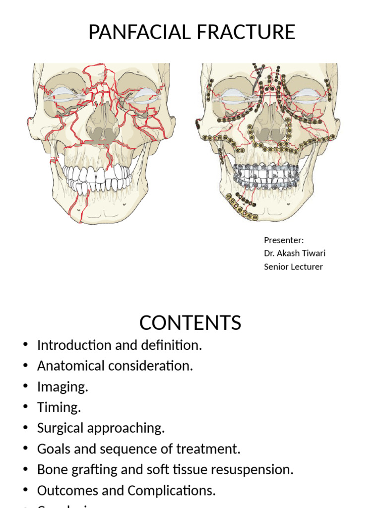 Panfacial Fracture | PDF | Human Nose | Human Head And Neck