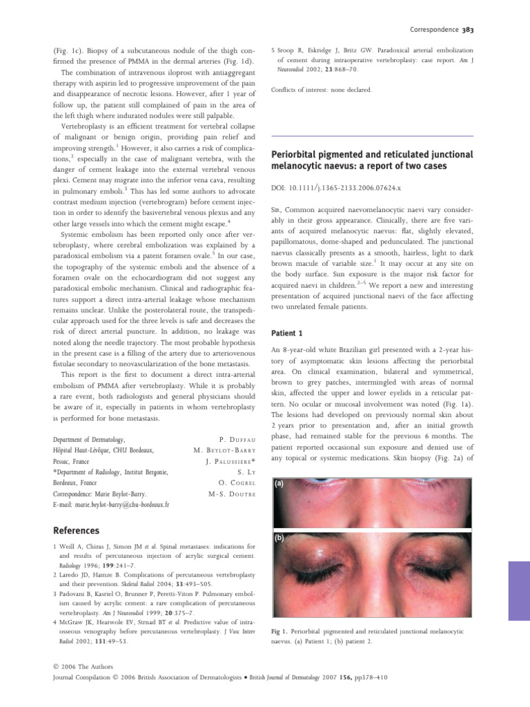 Periorbital Pigmented and Reticulated Junctional | PDF | Embolism | Vein