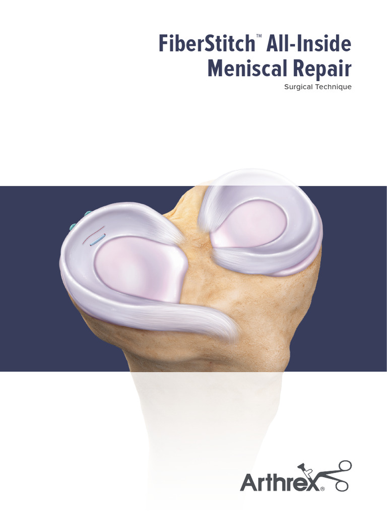Fiberstitch All Inside Meniscal Repair | PDF | Surgical Suture ...
