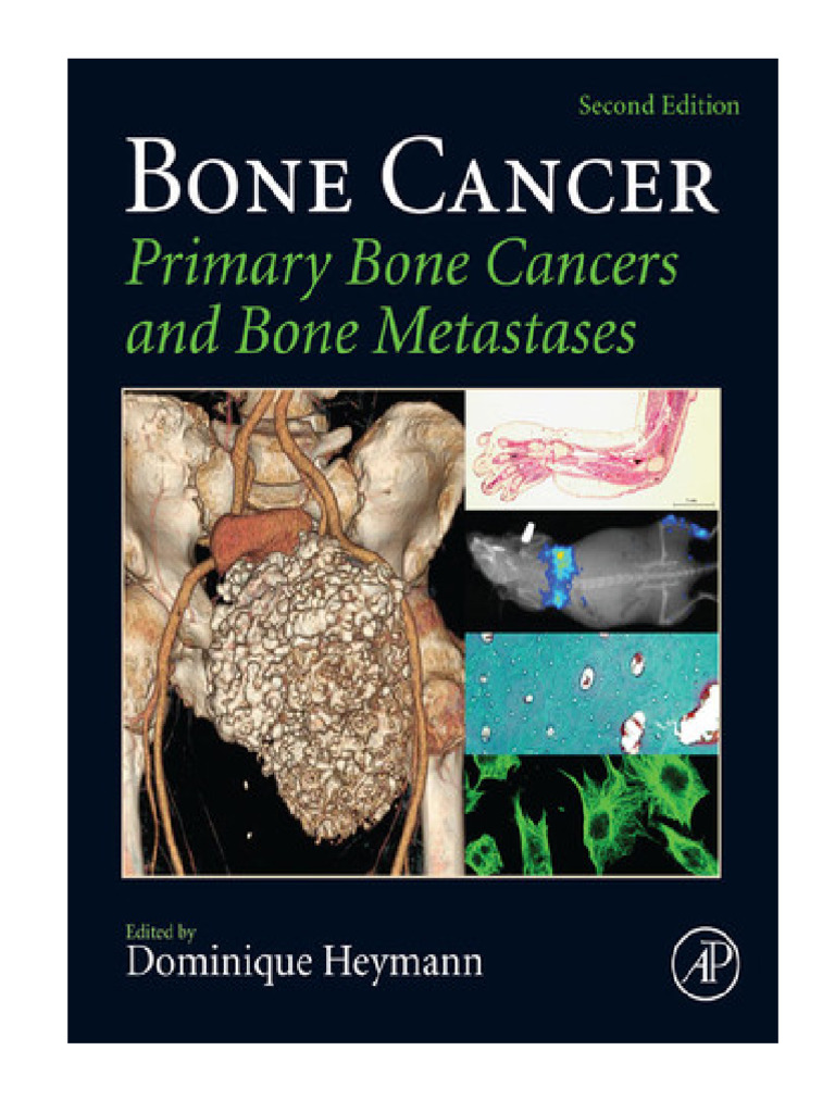 Bone Cancer: Primary Bone Cancers and Bone Metastases | PDF