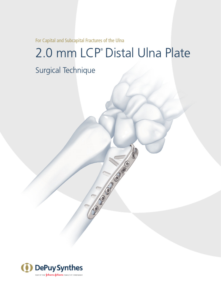2.0 mm LCP Distal Ulna Plate Guide | PDF | Musculoskeletal System