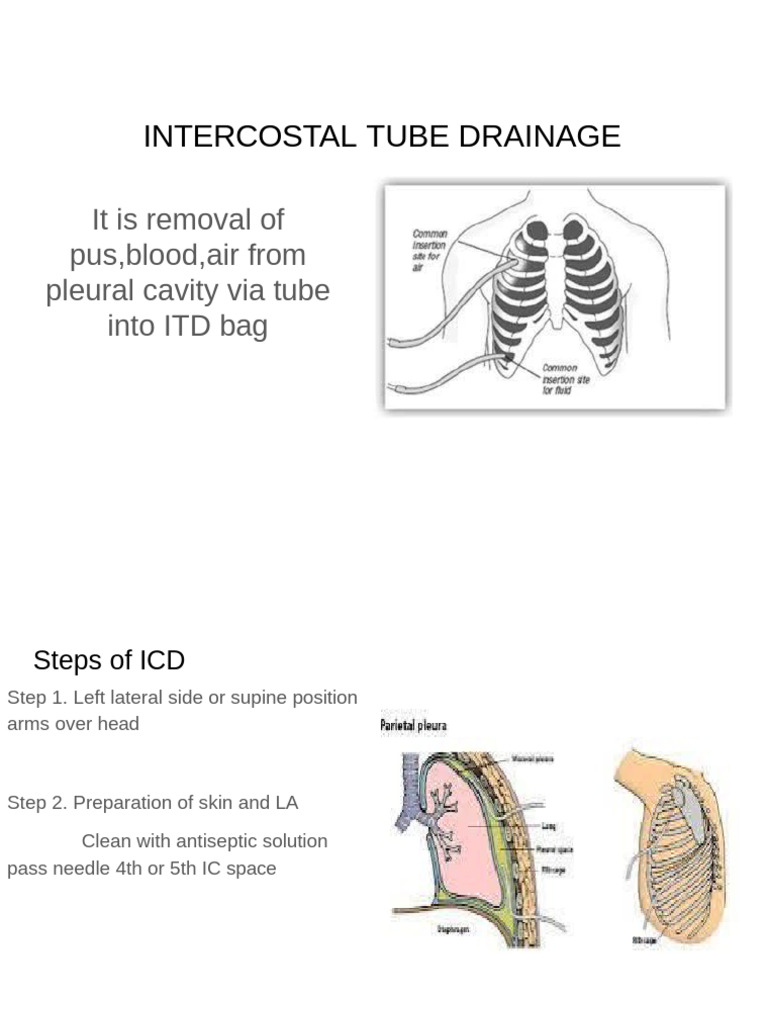 Intercostal Tube Drainage | PDF