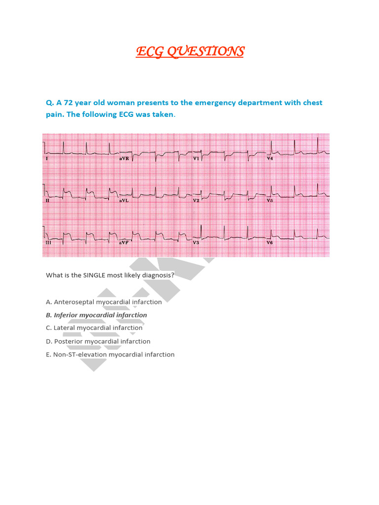 ECG NOTES | PDF | Electrocardiography | Myocardial Infarction