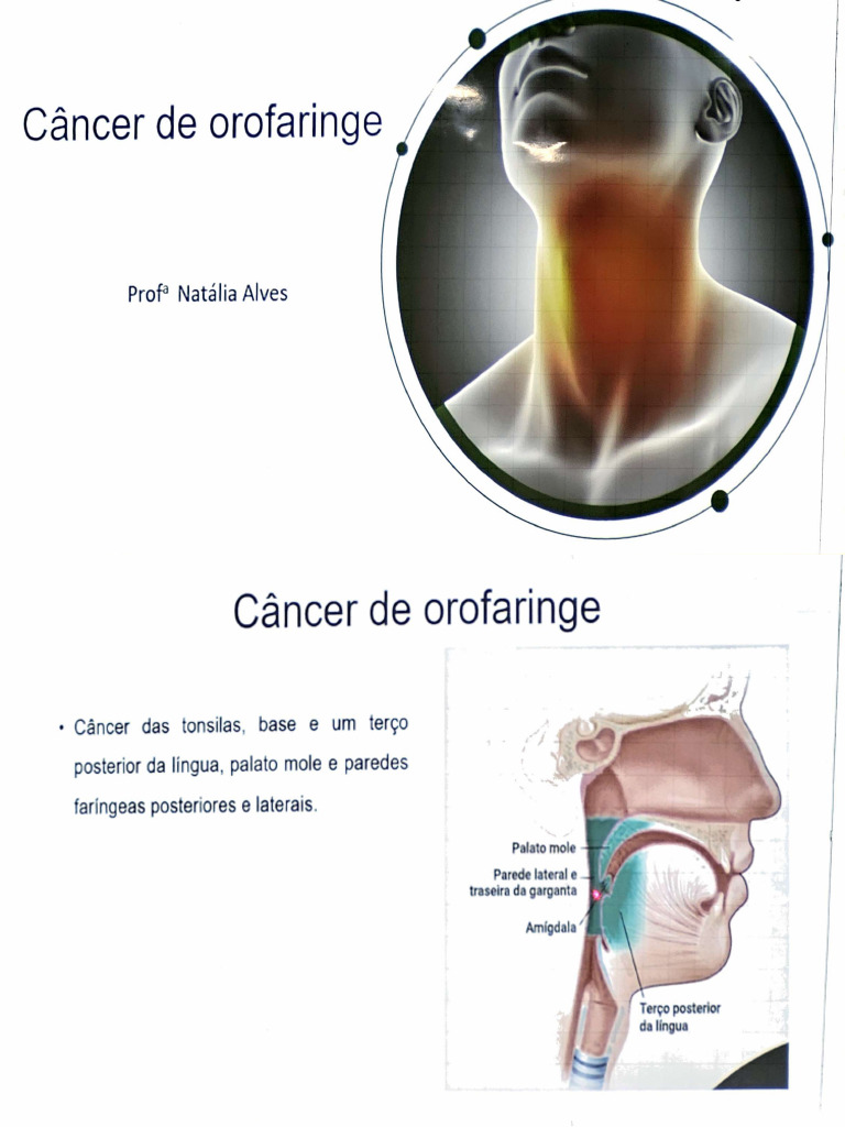 Câncer de Orofaringe | PDF