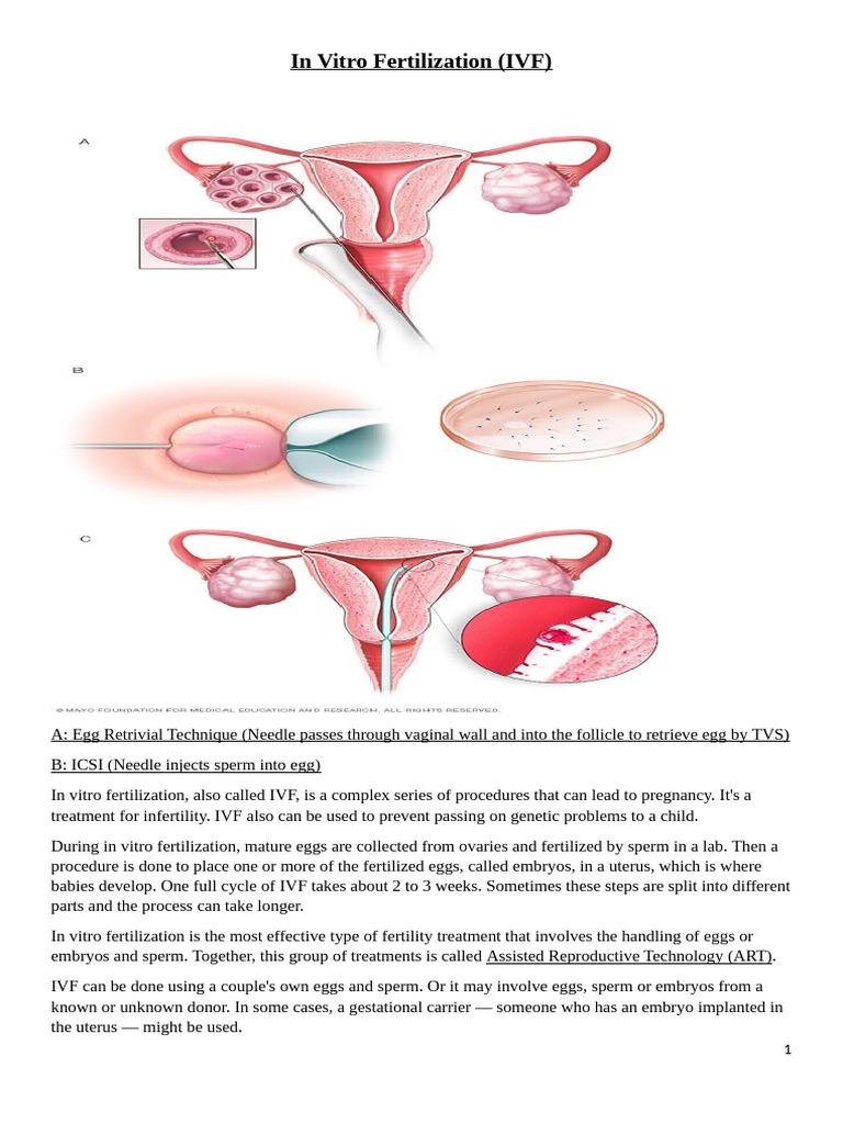 In Vitro Fertilization (IVF) | PDF | In Vitro Fertilisation | Ovary