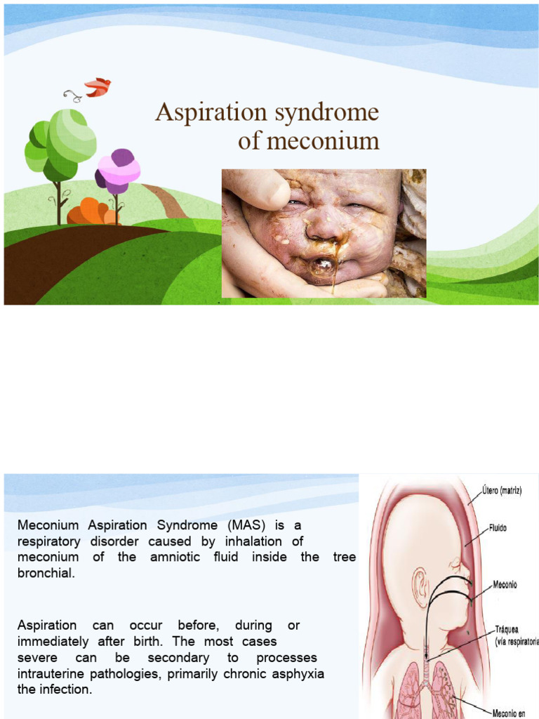 Meconium Aspiration Syndrome Overview | PDF | Respiratory Diseases ...