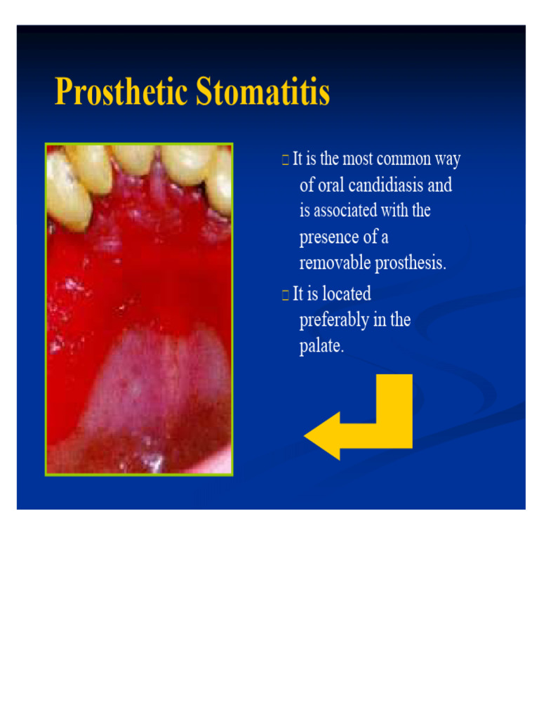 Prosthetic Stomatitis | PDF