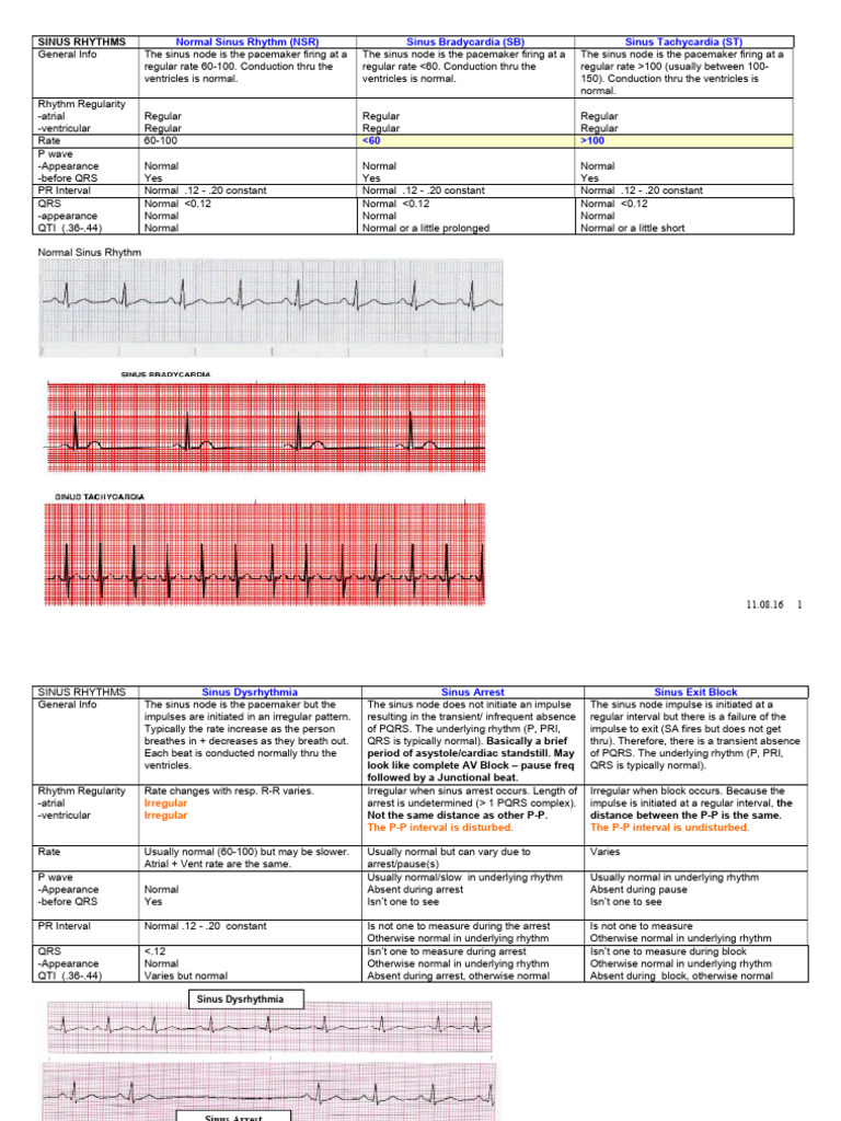 Normal Sinus Rhythm (NSR) Sinus Bradycardia (SB) Sinus Tachycardia (ST ...