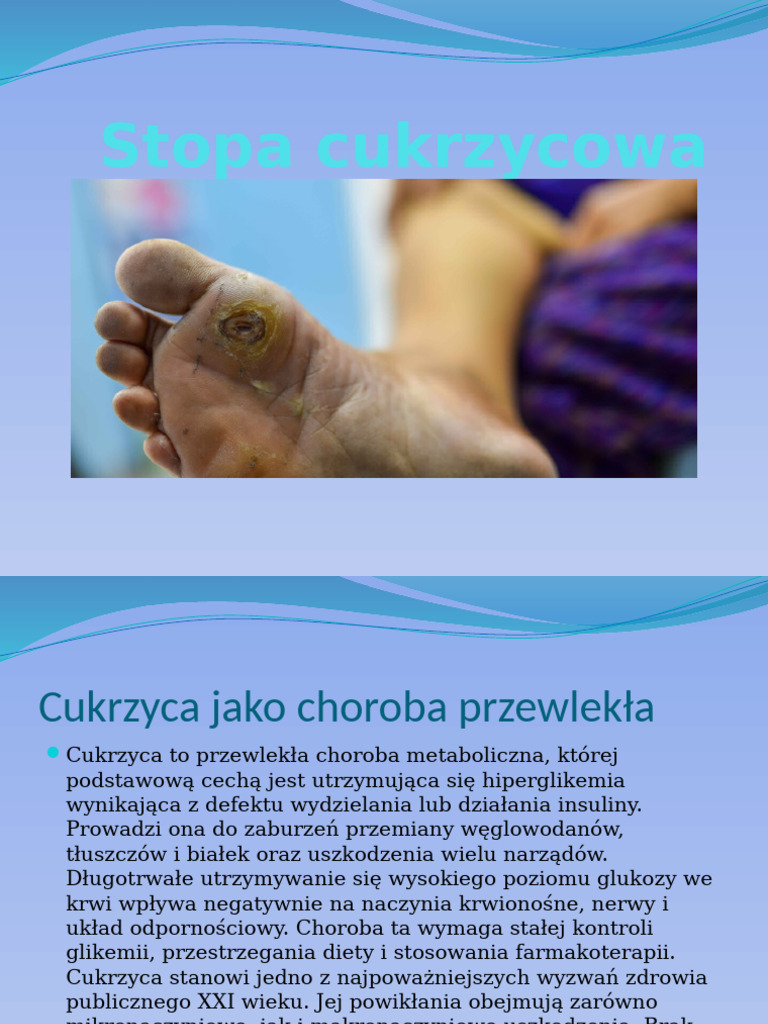 Stopa Cukrzycowa | PDF