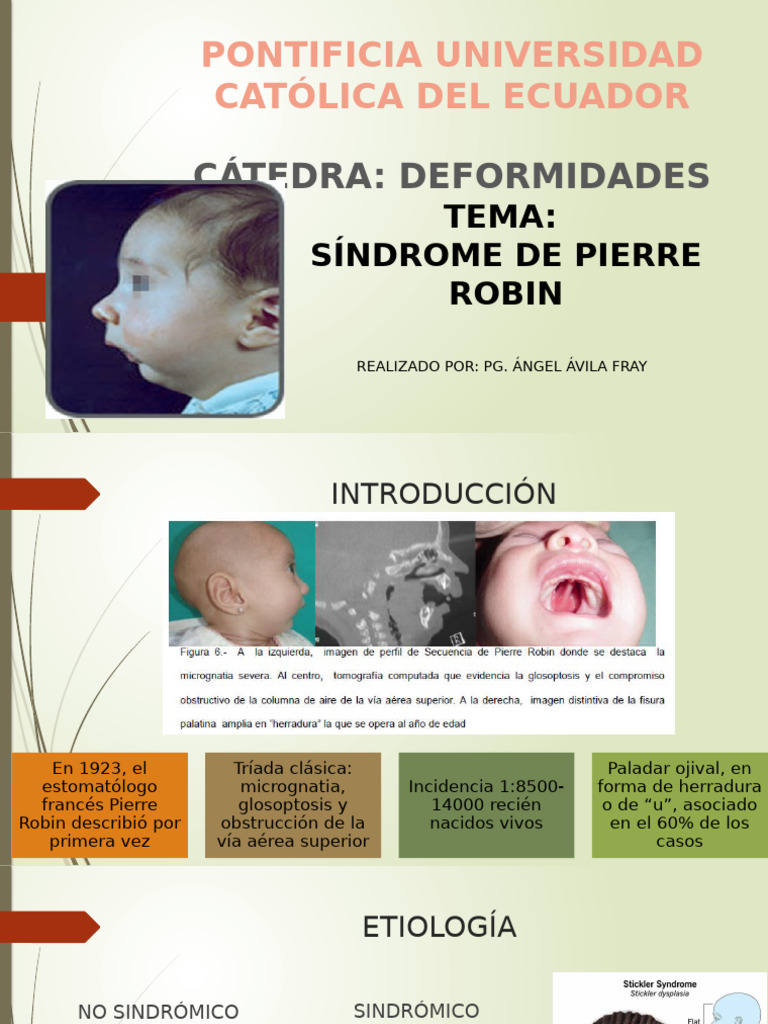 Síndrome de Pierre Robin: Diagnóstico y Tratamiento | PDF | Apnea ...