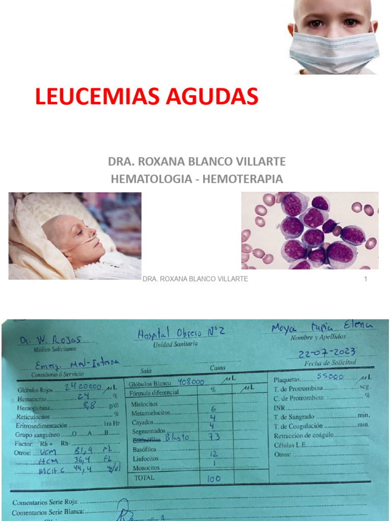 Leucemia Agudas Generalidades 2025 | PDF | Leucemia | Especialidades Medicas