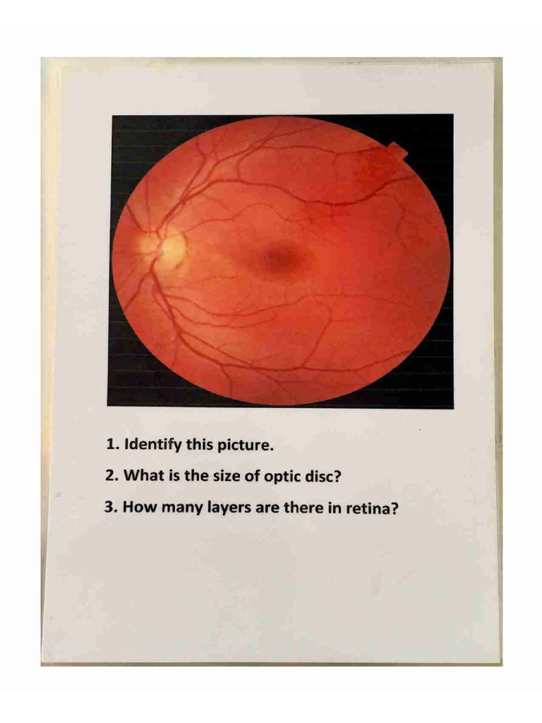 Ophthal Osce Final | PDF