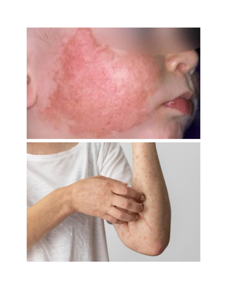 Poze - Dermatoze Alegice 1 | PDF