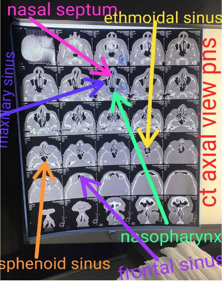 Ent Imaging Ospe 2 | PDF