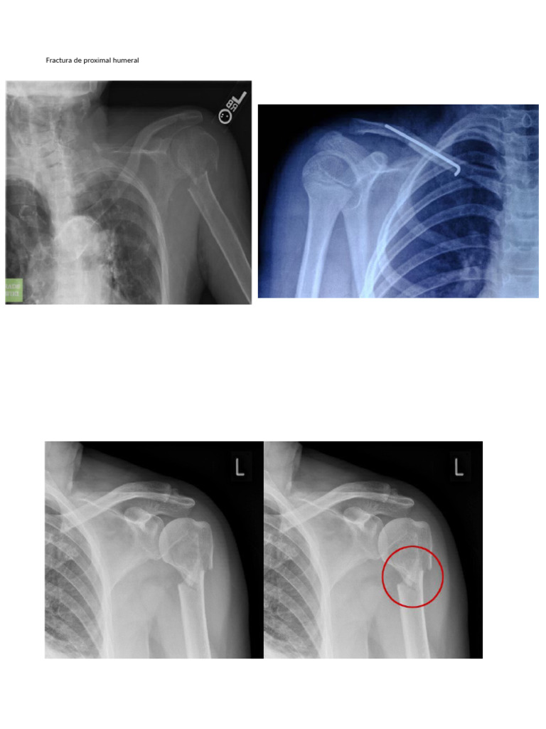 Fractura de Proximal Humeral | PDF