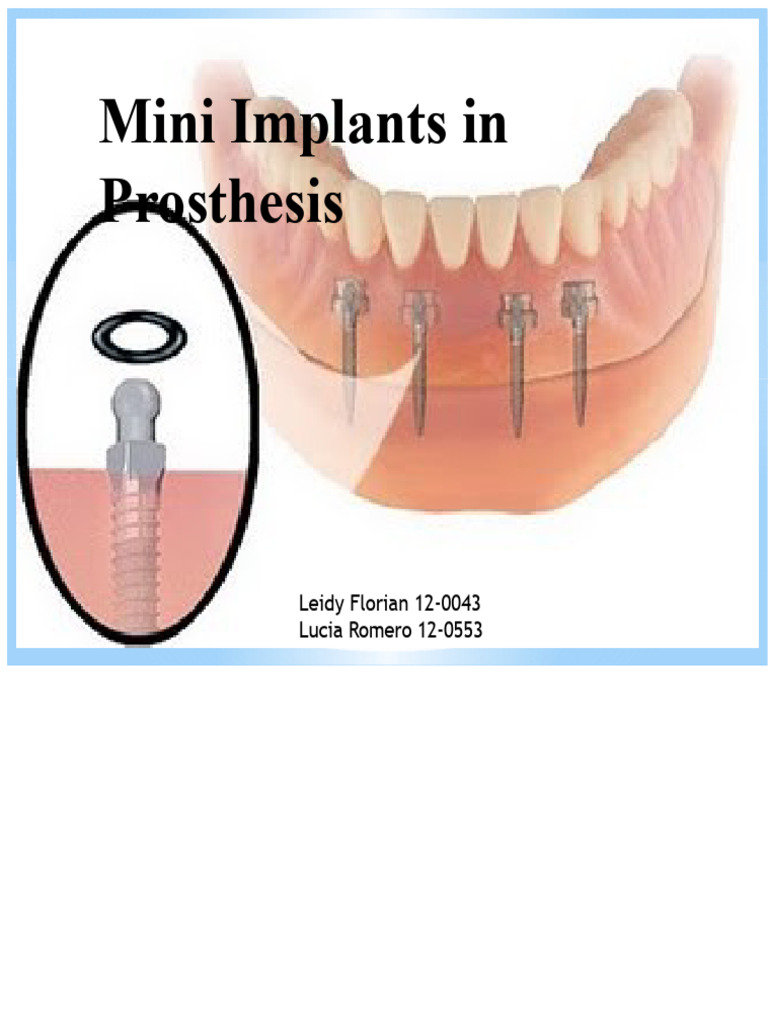 Benefits and Care of Mini Implants | PDF | Dental Implant | Dental Anatomy