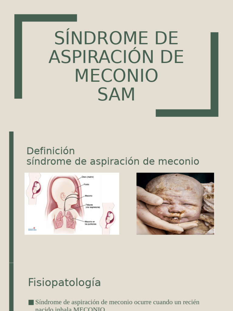 Síndrome de Aspiración de Meconio | PDF | Neumonía | Parto