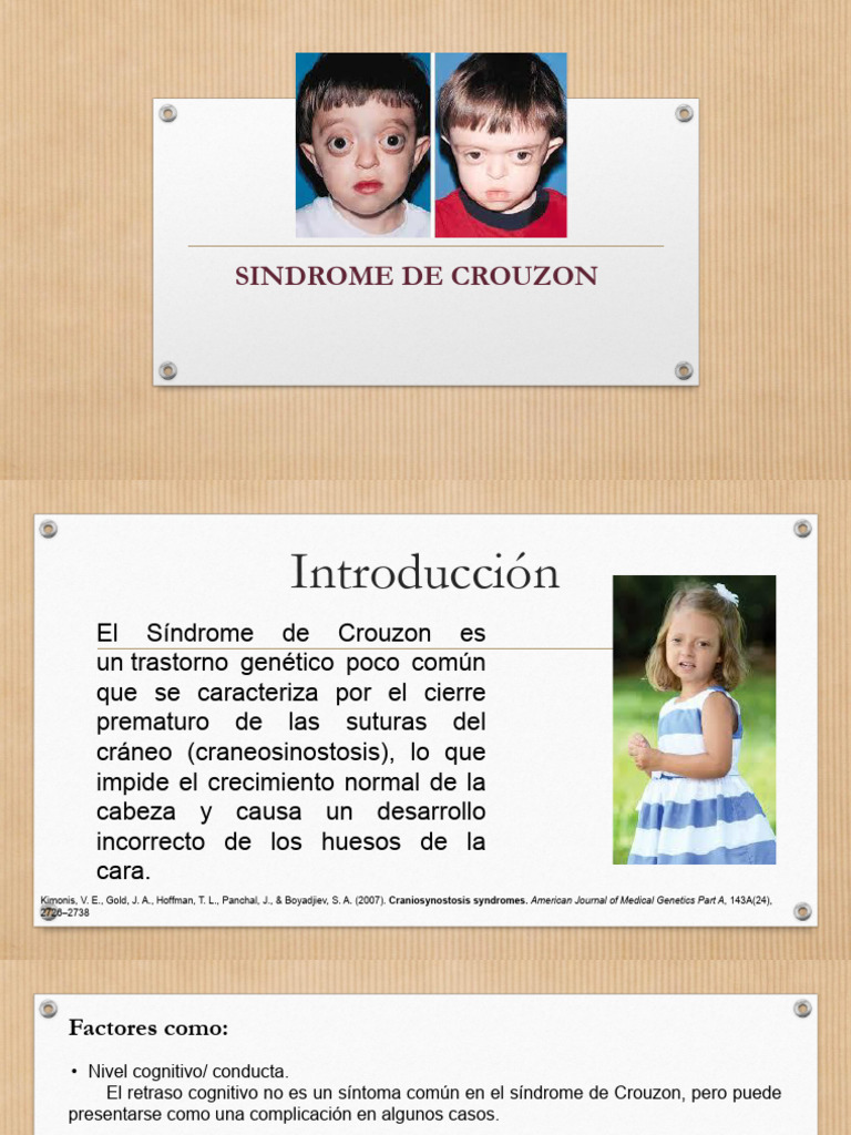 Síndrome de Crouzon: Características y Tratamiento | PDF | Ortodoncia ...