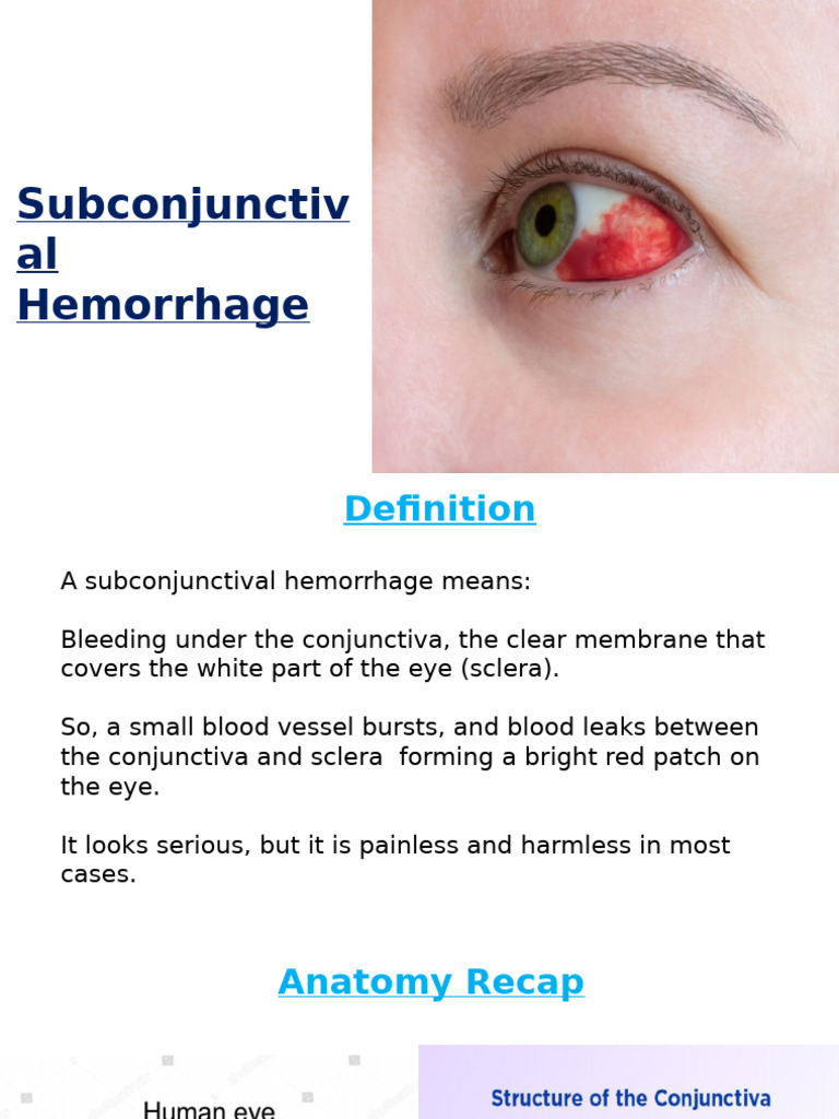Subconjunctival Hemorrhage Overview | PDF | Bleeding | Medical Specialties