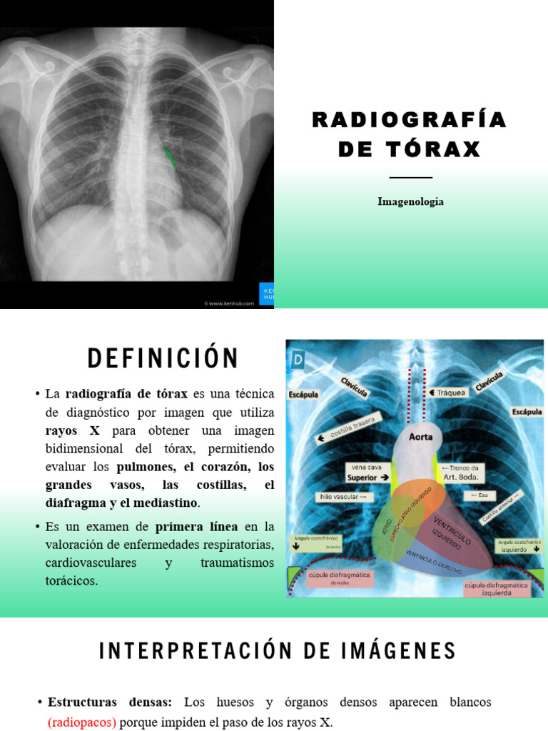 RX tórax Pedro | PDF | Tórax | Especialidades Medicas
