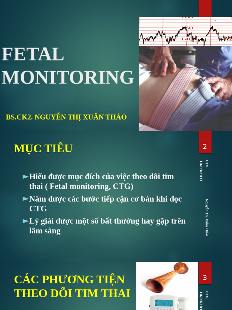 Fetal Monitoring - NST-ST | PDF