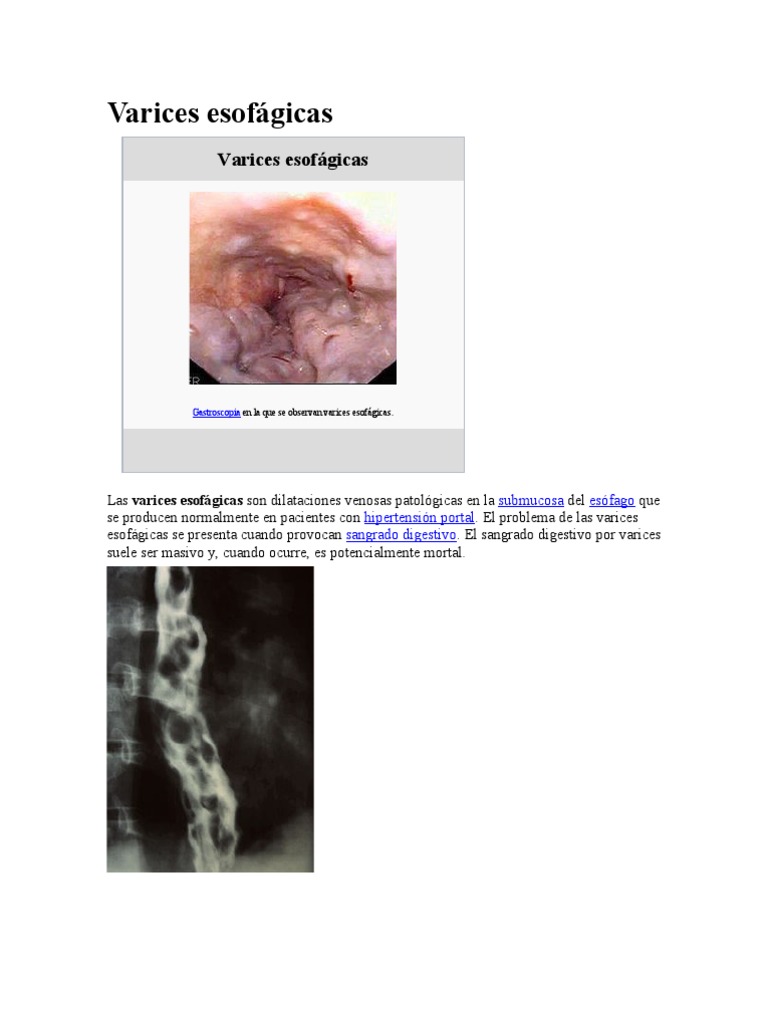 Varices esofágicas | Cirrosis | Órgano (anatomía) | Prueba gratuita de ...
