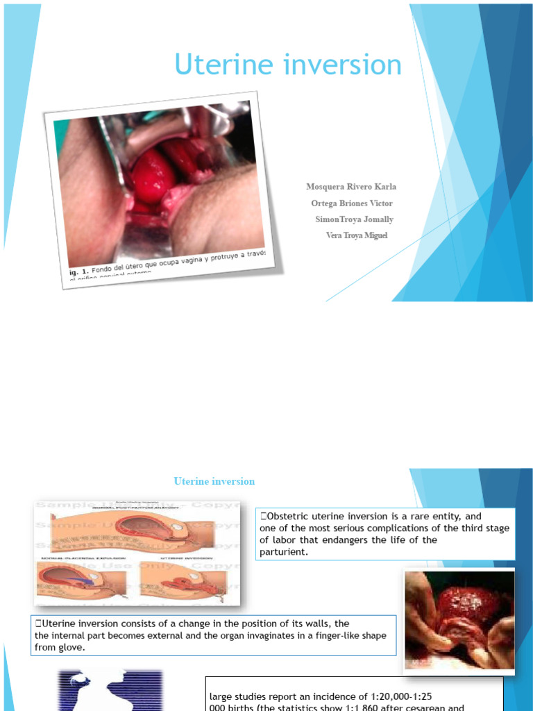 Uterine Inversion | PDF | Uterus | Vagina