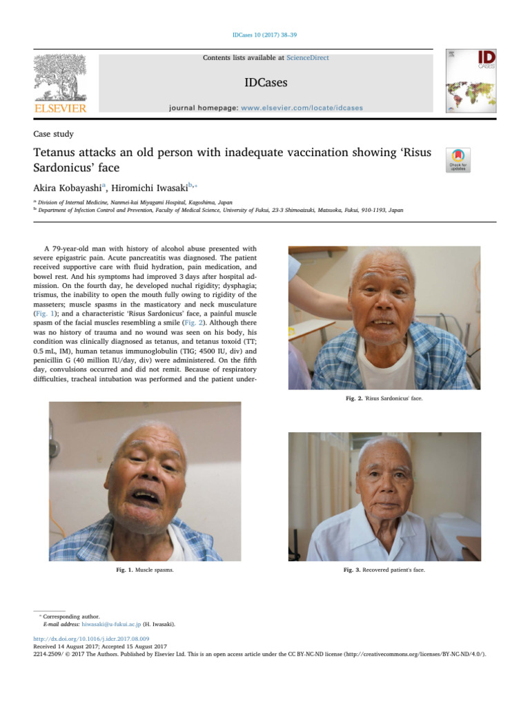 Tetanus Attacks an Old Person With Inadequate Vaccination Showing 'Risus Sardonicus' Face | PDF ...
