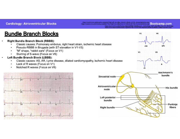 Bundle Branch Block | PDF
