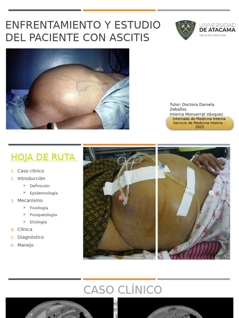 AScitis | PDF | Cirrosis | Especialidades Medicas