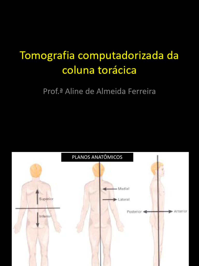 Tomografia Computadorizada da Coluna Torácica | PDF | Sistema ...